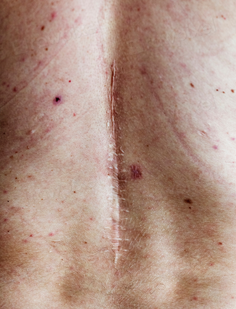 Elderly person back surgery scar | Premium Photo - rawpixel