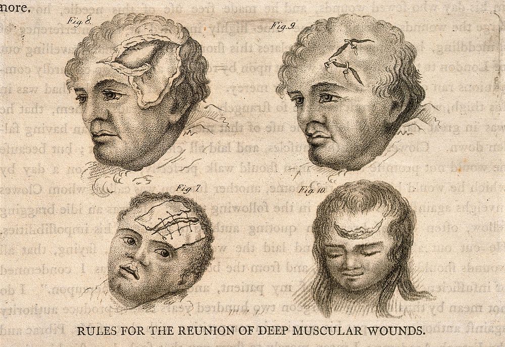 Four diagrams illustrating heads severe | Free Photo Illustration ...