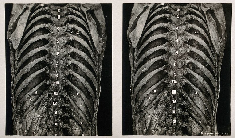 Anatomy: dissection thorax: back. Photograph | Free Photo - rawpixel