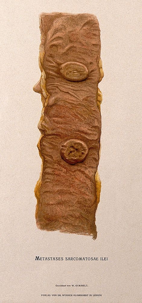 Dissection diseased intestine. Chromolithograph W | Free Photo ...