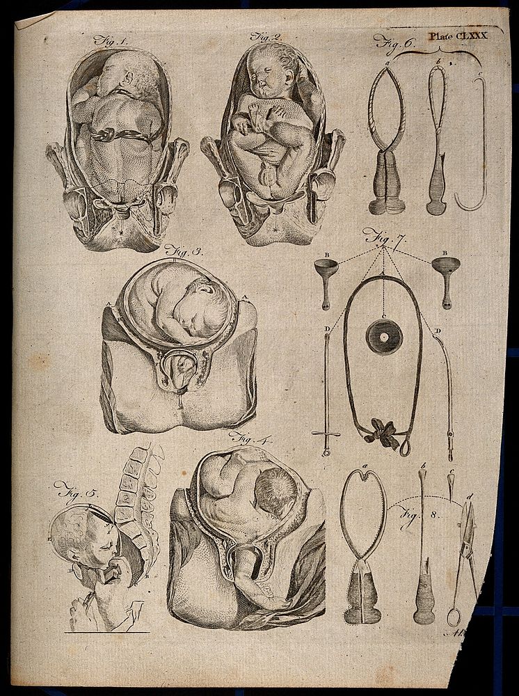 Eight diagrams illustrating difficult births | Free Photo Illustration ...