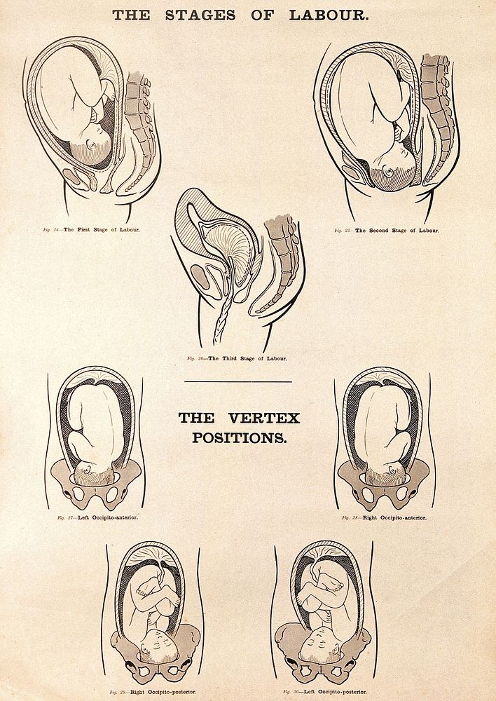 stages labour vertex positions. Lithograph | Free Photo Illustration ...