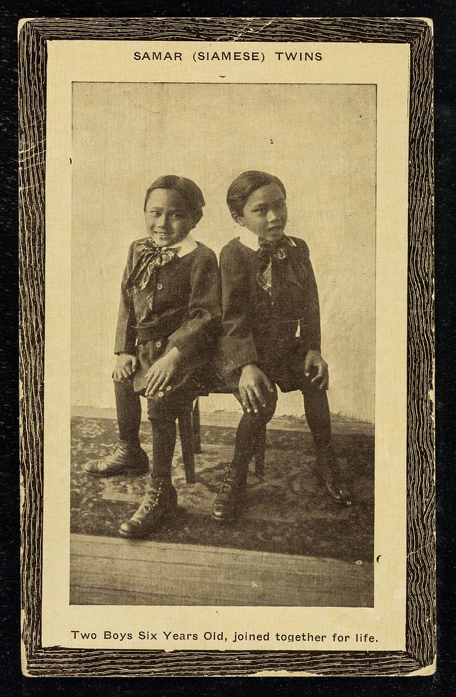 Samar (Siamese) twins : two | Free Photo Illustration - rawpixel