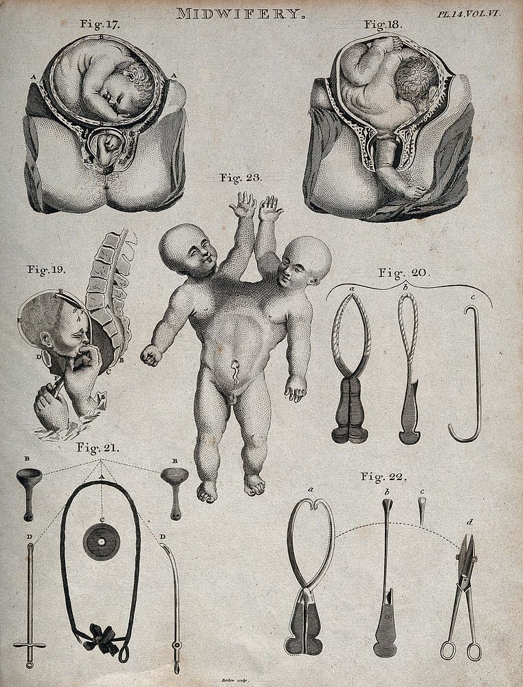 Seven diagrams illustrating difficult births, | Free Photo Illustration ...