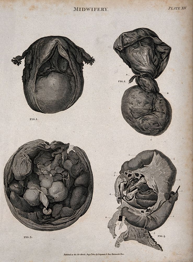 Four diagrams abnormal female uterus. | Free Photo Illustration - rawpixel