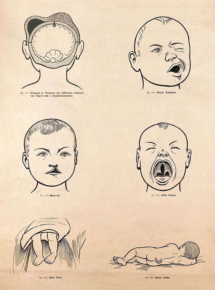 Birth-defects new-born child. Lithograph W. | Free Photo Illustration ...