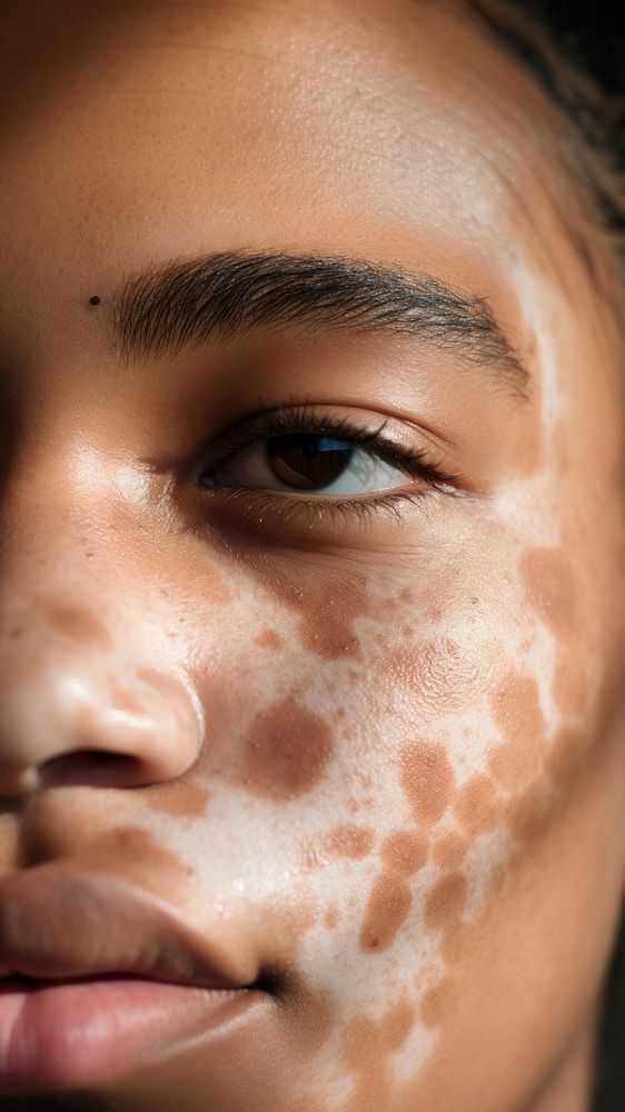 Woman's face vitiligo skin, closeup. | Free Photo - rawpixel
