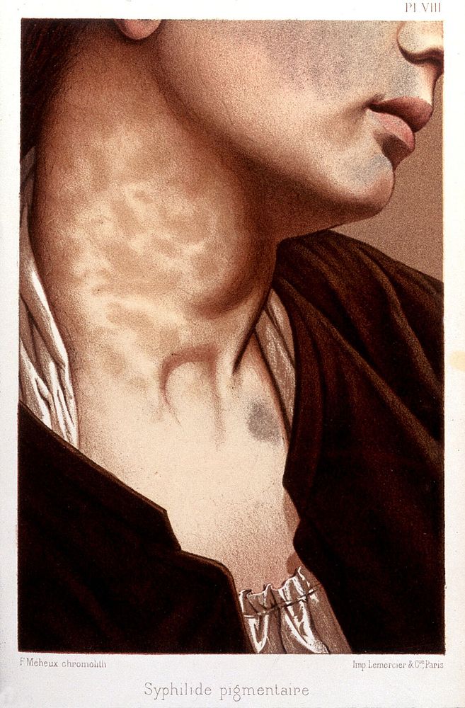 Photographic illustrations cutaneous syphilis / | Free Photo - rawpixel