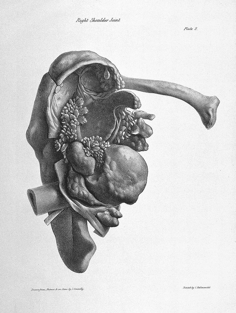 Illustrations effects rheumatic gout chronic | Free Photo Illustration ...