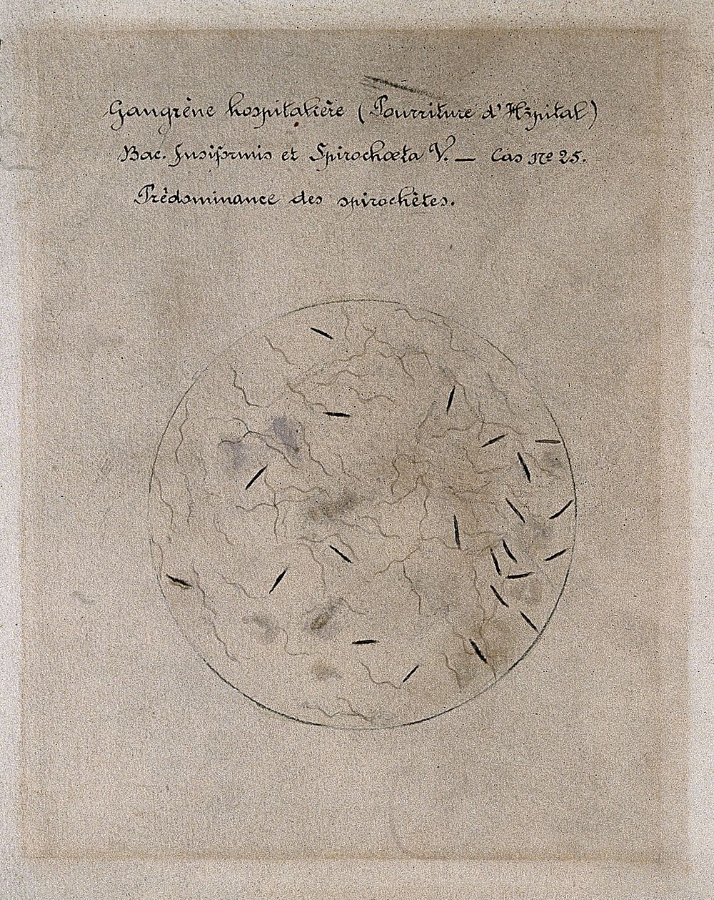 Hospital gangrene, fusiform bacillus spirochetes | Free Photo ...