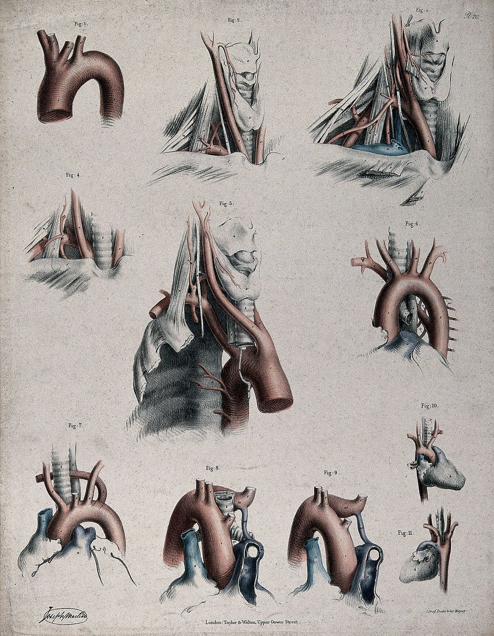 circulatory system: dissections showing aortic | Free Photo ...